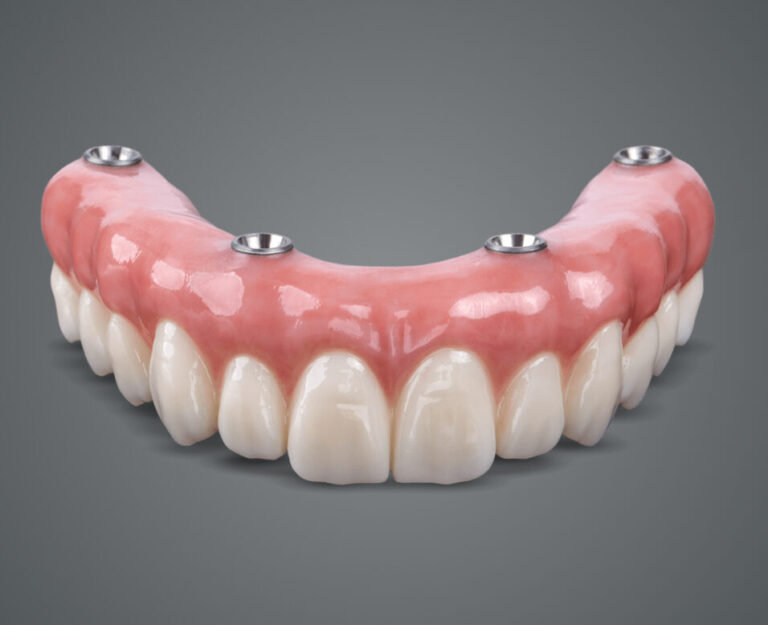 Permanent Fixed Dentures Over Implants | Castledowns Denture Clinic